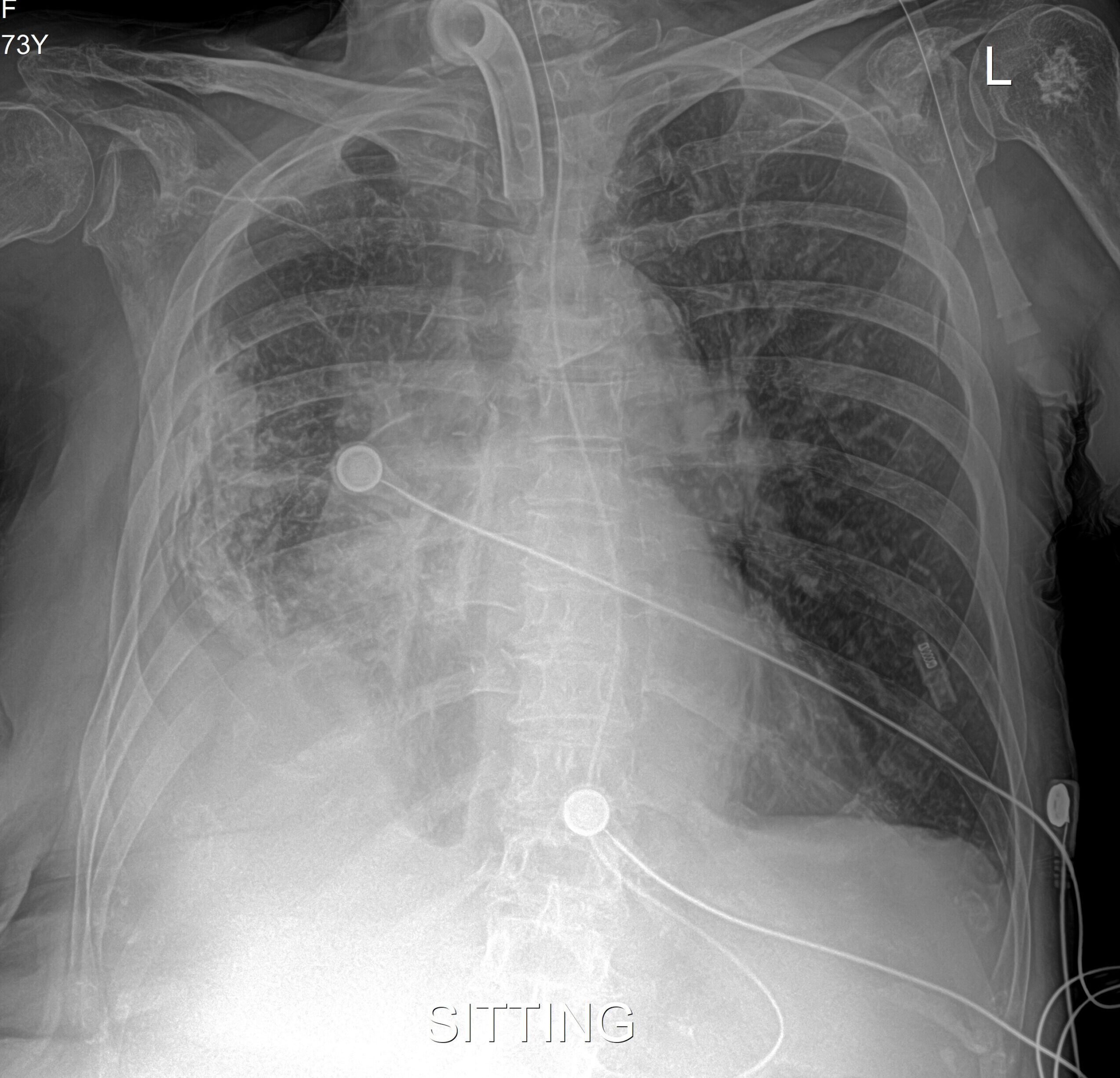 Σύγκλειση της Τραχειοστομίας σε Ασθενή με Χρόνια Αποφρακτική Πνευμονοπάθεια